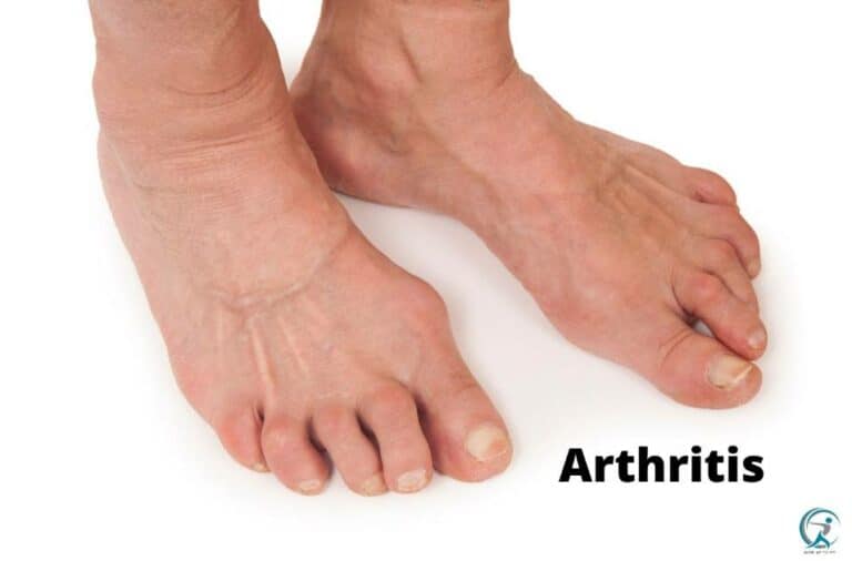 7 Proven Achilles Tendonitis Treatment Secrets for Runners