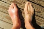 Avoid Common Foot Problems For Runners - Gear Up to Fit